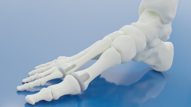 BioPoly gains FDA clearance for second toe implant – Inside INdiana ...